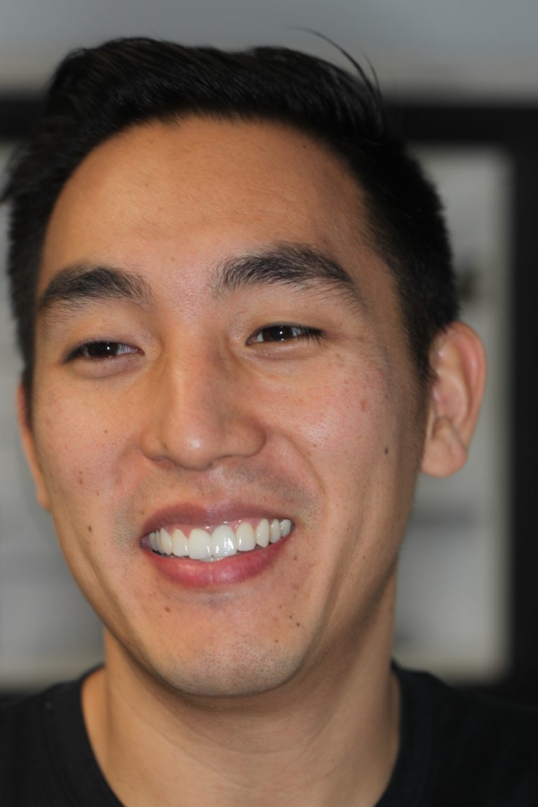 Maximizing Motion of a Custom Fit Ocular Prosthesis